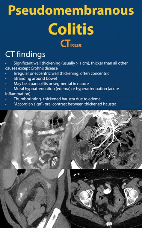 Ctisus On Linkedin Pseudomembranous Colitis Ct Findings