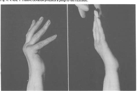 Habitual Extensor Tendon Dislocation Semantic Scholar