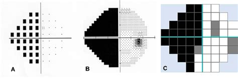 Examples Of Visual Field Results From The Software Compare With Download Scientific Diagram