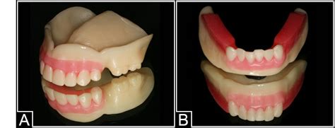 3 Step Protocol For Digital Denture Fabrication Abadent Wagner