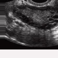Pcos Detection Object Detection Model V Am By Pcos Dataset
