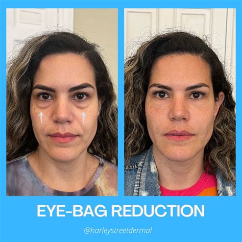 Dark Bags Under Eyes Treatment