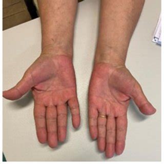 Erythema And Edema Of The Palms Compatible With Acral Erythema Download Scientific Diagram