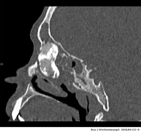 Giant Fronto Ethmoidal Osteoma Selection Of An Optimal Surgical