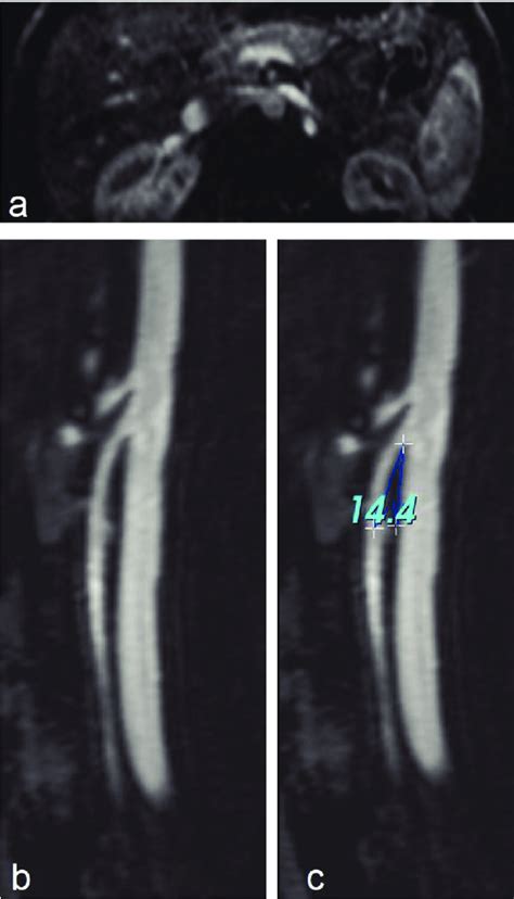 Nutcracker Syndrome Mri At Randal Canada Blog
