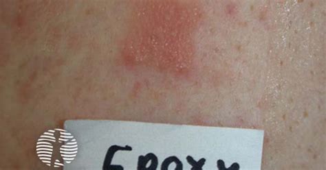 Patch Test Image