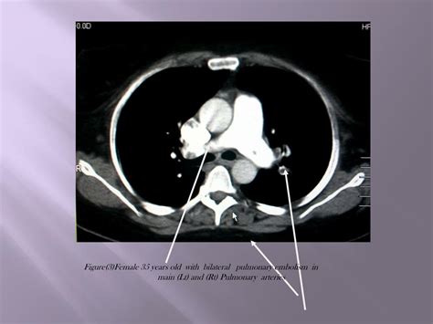 Ppt Evaluation Of Acute Pulmonary Embolism Using Spiral Ct Scan