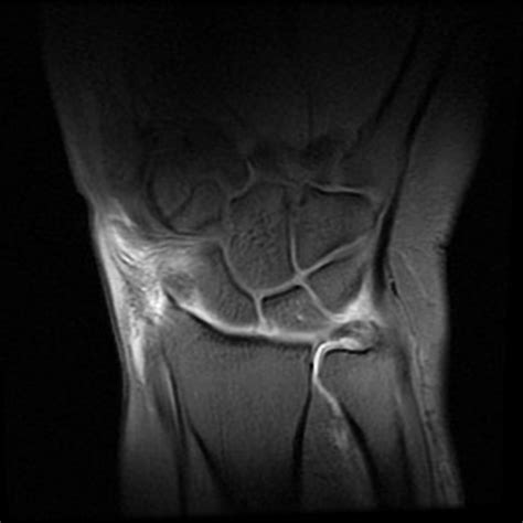 삼각섬유연골복합체 Triangular Fibrocartilage Complex 손상에 대해 알아보아요 네이버 블로그