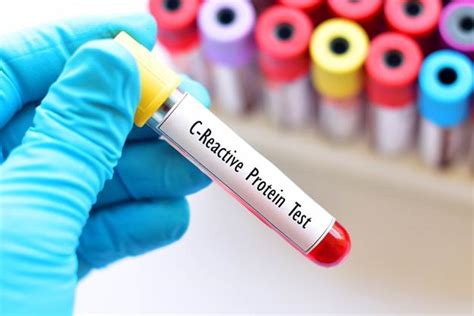 Understanding C Reactive Protein The Link Between Inflammation And Health The Fact Diagnostics
