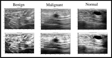 Figure 5 From Breast Cancer Segmentation Using Attention Based