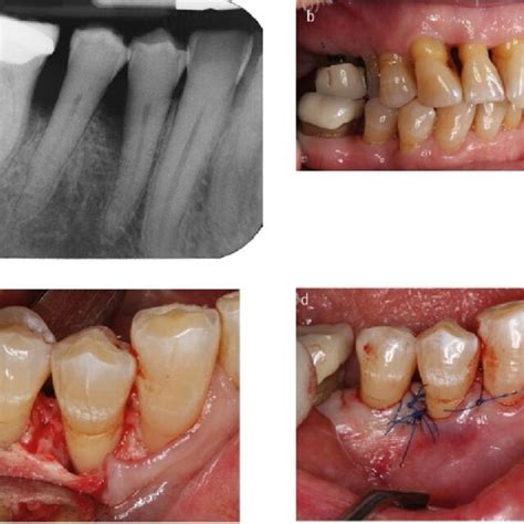 44 Distal Intrabony Defect Treated With Enamel Matrix Derivative A
