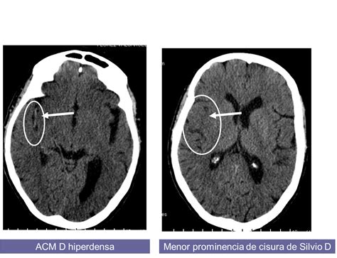 Tratamiento Endovascular Del Ictus Agudo Ii Consulta De Neurologia