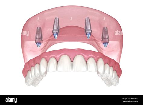 Maxillary Prosthesis With Gum All On 4 System Supported By Implants Medically Accurate 3d