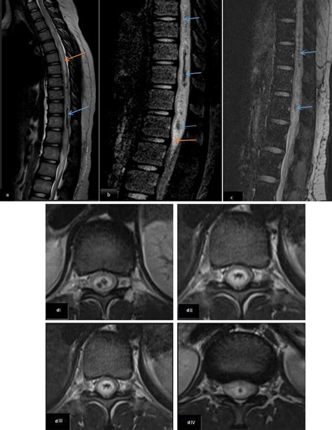 A T2 W Sagittal Image And B Flair Sagittal Image Showing A Long Segment Download Scientific