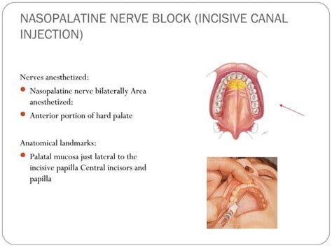Maxillary Injection Techniques Ppt