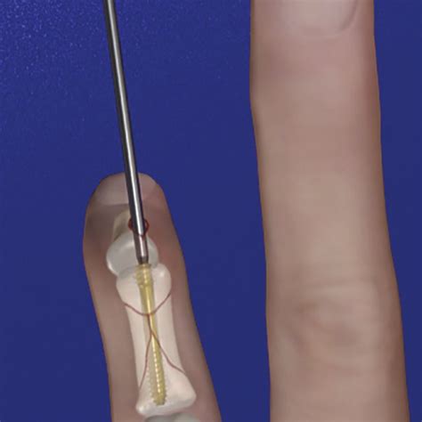 Pdf Intramedullary Compression Screw Fixation Of Metacarpal And Phalangeal Fractures