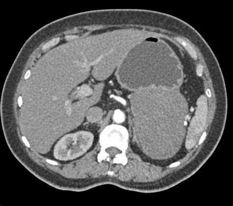 Inside The Stomach Tumor
