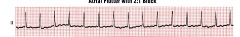 7 Atrial Flutter With 2 1 Atrioventricular Av Conduction