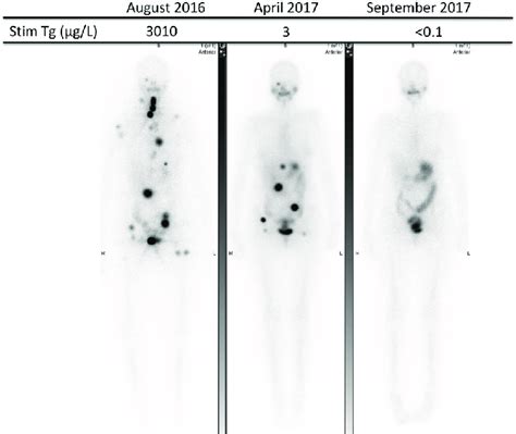I 131 Post Ablation Scans And Corresponding Stimulated Thyroglobulin
