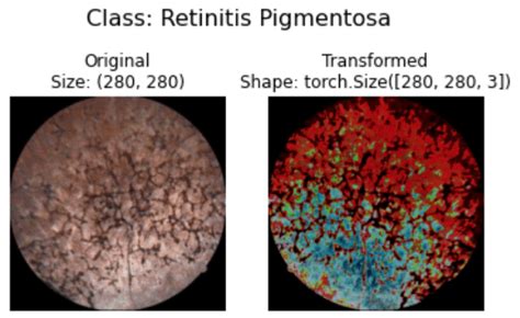 Deep Learning Platform For Fundus Image Prediction R Ophthalmology