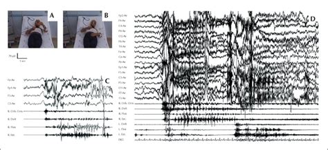 JLE Epileptic Disorders Faciobrachial Dystonic Seizures Expressed As Epileptic Spasms