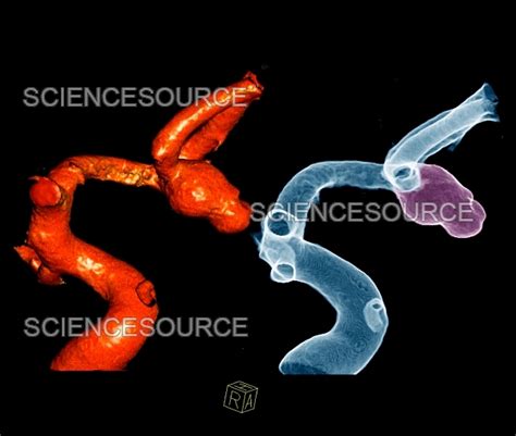 Cerebral Aneurysm 3d Ct Scans Stock Image Science Source Images