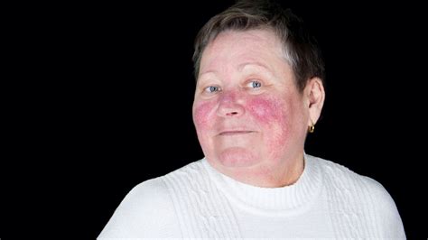 Blue Skin Disorder Causes Symptoms And Case Studies Tychr