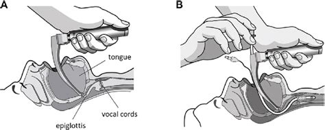 Endotracheal Intubation