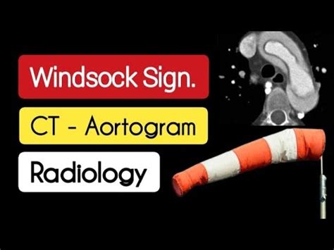 Windsock Sign CT Aortogram Intimointimal Intussusception In Aortic Dissection YouTube