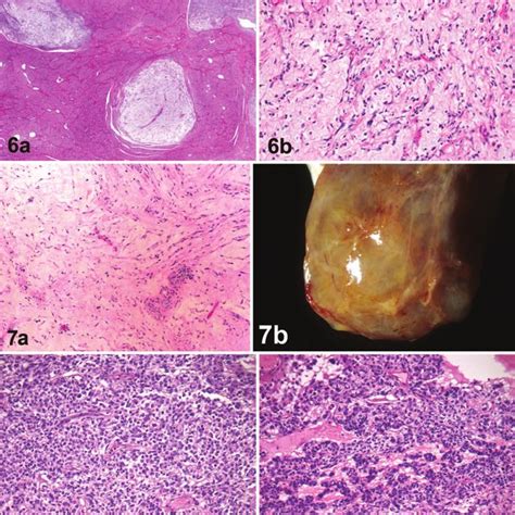 Main Types Of Necrosis In Smooth Muscle Tumors A Tumor Cell Necrosis