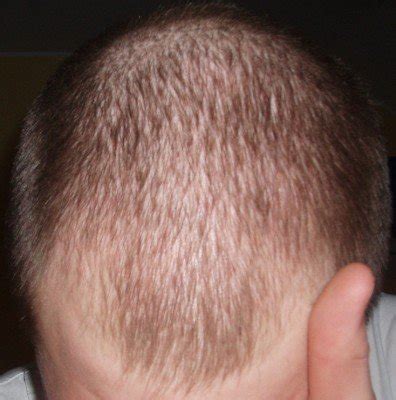 Diffuse Patterned Alopecia Know These Hair Loss Facts