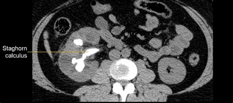 Pyelonephritis • Litfl • Ffs
