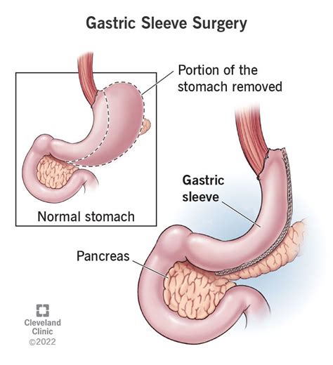 Best 13 Gastric Sleeve Surgery What It Is Requirements Artofit