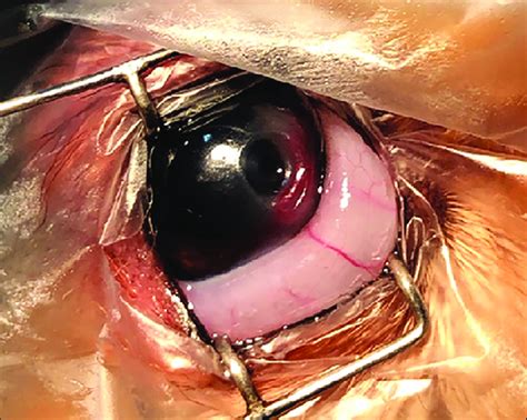 Eye Affected By Deep Corneal Ulcer After Performing Hydrodissection