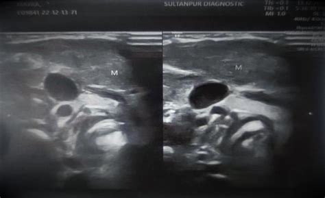 Neonate With A Firm Swelling In The Anterolateral Aspect Of The Neck Download Scientific