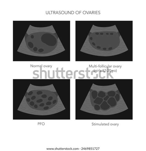 Medical Vector Illustration Ovaries Ultrasound Normal Stock Vector