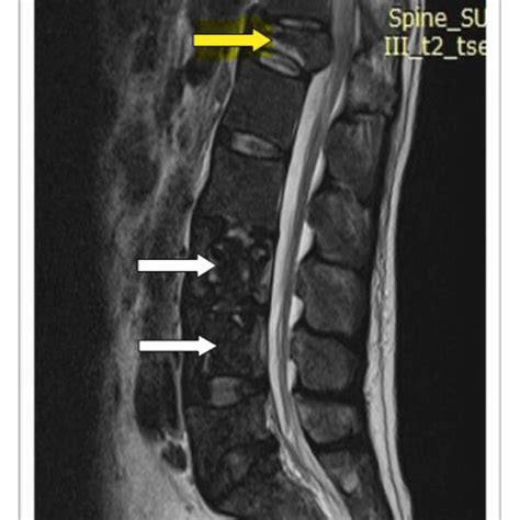 A Osteonecrosis Of Vertebral Bodies L3 And L4 White Arrows And