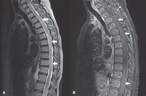 Scielo Brasil Magnetic Resonance Imaging Evaluation Of Spinal Cord