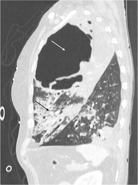 Giant Lung Abscess Complicating Pneumonia Managed With Veno Venous