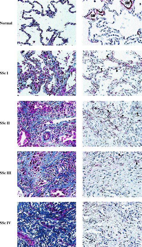 Figure 1 From Myofibroblast Induction And Microvascular Alteration In Scleroderma Lung Fibrosis