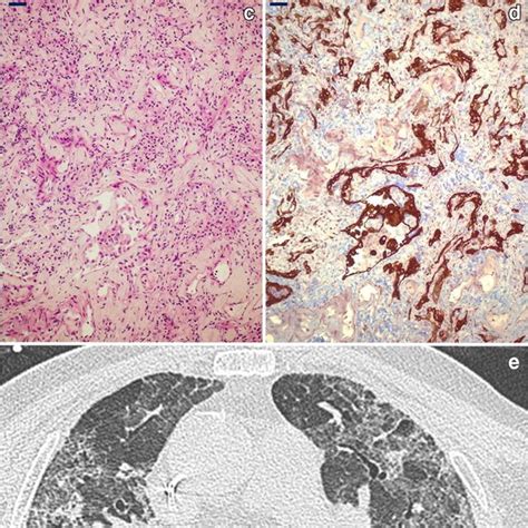 Histology And Radiology Of Lateorganizing Phase Of Dad Pattern