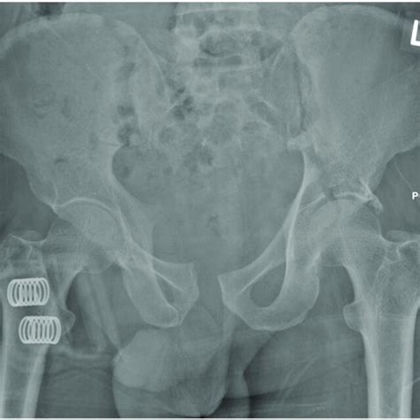 Initial Antero Posterior Ap Pelvic Radiograph Showing Pelvic Ring Download Scientific Diagram