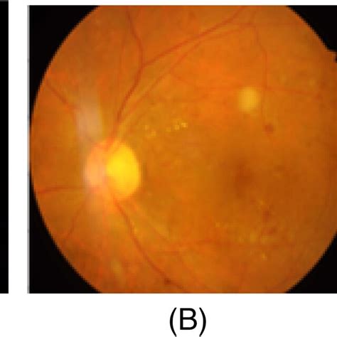 Pre‐processing Of A Retinal Fundus Image Of Idrid Dataset A Gray Download Scientific Diagram