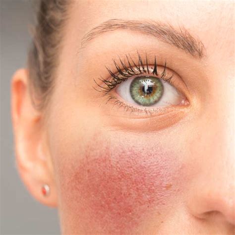 Rosy Cheeks Vs Rosacea At Frank Royalty Blog