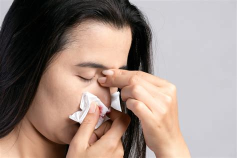 Epistaxis Nosebleeds Sinushealth