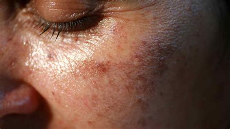 Sunlight Vs Pimples Is Sun Good Or Bad For Acne