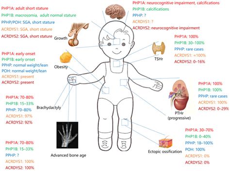 Recommendations For Diagnosis And Treatment Of Pseudohypoparathyroidism And Related Disorders