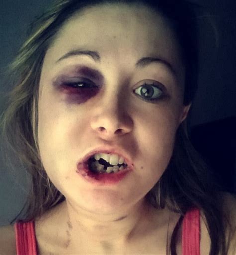 Sickening Images Show Young Mum Brutally Beaten Black And Blue After