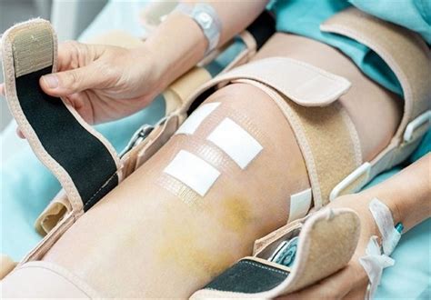 مدت زمان بهبودی کامل بعد از عمل تعویض مفصل زانو 10 راهکار مراقبتی