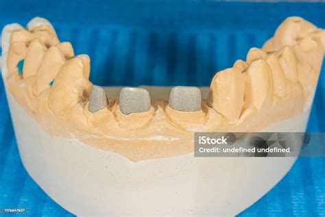 치과 실험실에서 석고 모델 클로즈업에 인간의 치아의 금속 캐스트 핀 크라운 복원을위한 정형 외과 치과 준비 개념에 대한 스톡